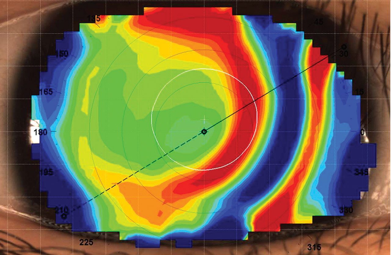 IS THIS THE NEW NORM? | Contact Lens Spectrum