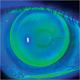 GP INSIGHTS | Contact Lens Spectrum