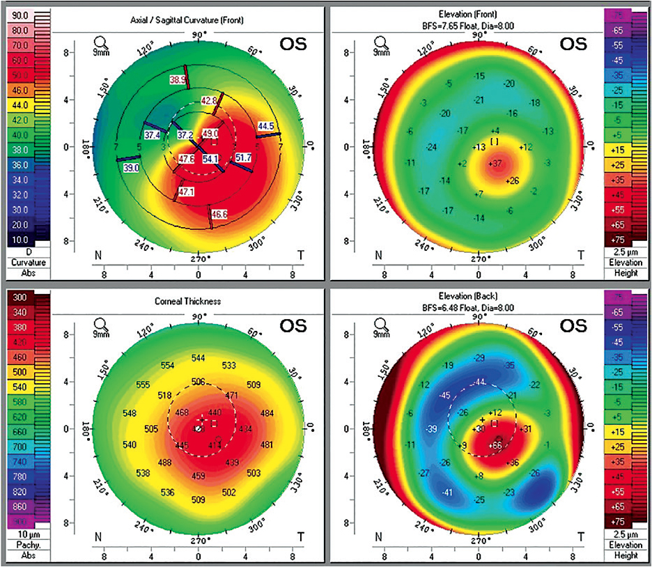 Contact Lens Spectrum | PentaVision