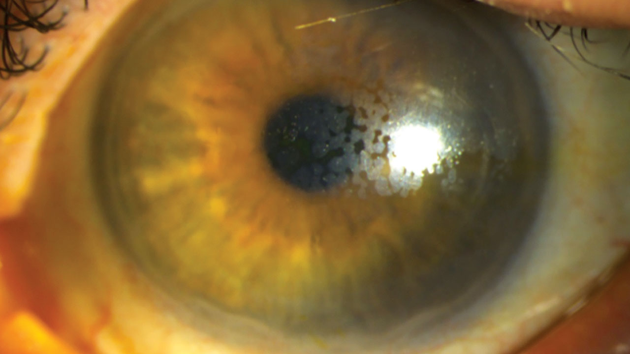 Dry Eye Dx and Tx: Treat Dry Eye Before Specialty CL Fitting | Contact ...