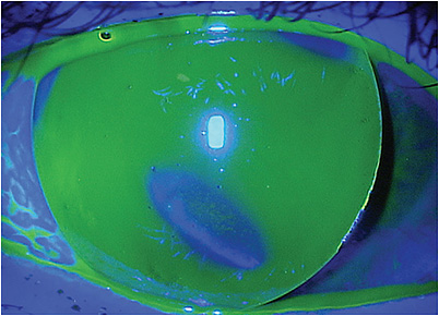 GP INSIGHTS | Contact Lens Spectrum