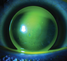 Contact Lens Spectrum | PentaVision
