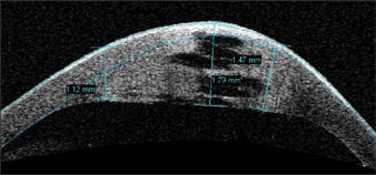 Contact Lens Spectrum | PentaVision