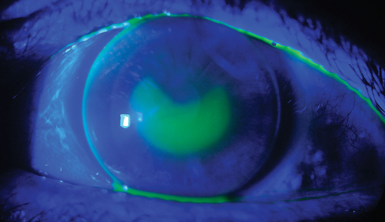 ONLINE PHOTO | Contact Lens Spectrum