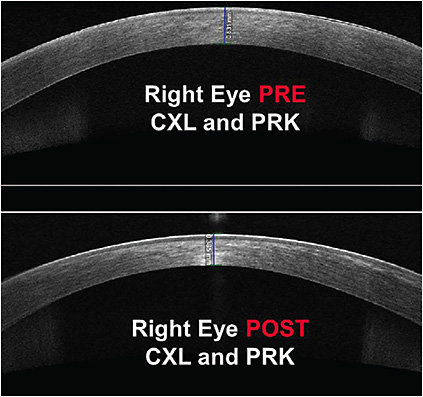 Contact Lens Spectrum | PentaVision