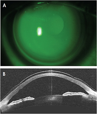 Contact Lens Spectrum | PentaVision