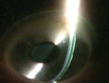 Contact Lens Spectrum | PentaVision