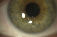 Contact Lens Spectrum | PentaVision