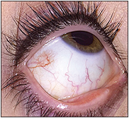 Contact Lens Spectrum | PentaVision