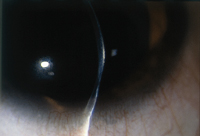 Contact Lens Spectrum | PentaVision