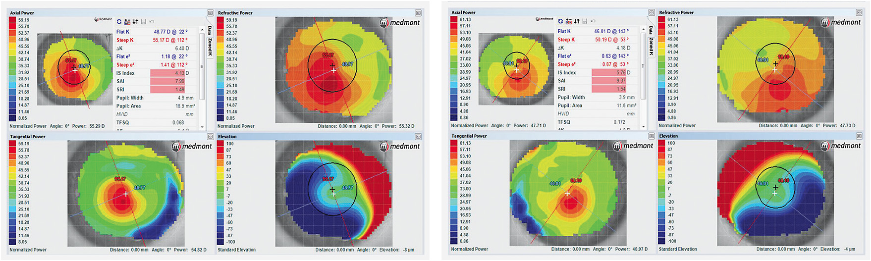 Contact Lens Spectrum | PentaVision