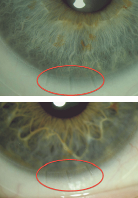 Contact Lens Spectrum | PentaVision