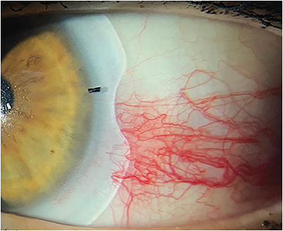 Contact Lens Spectrum | PentaVision