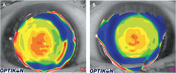 Contact Lens Spectrum | PentaVision