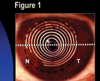 Contact Lens Spectrum | PentaVision