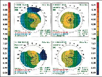 Contact Lens Spectrum | PentaVision
