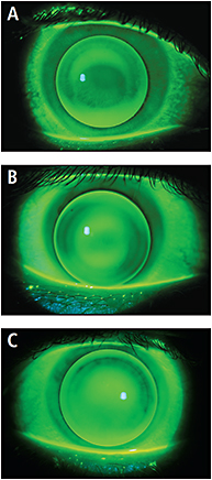 Contact Lens Spectrum | PentaVision
