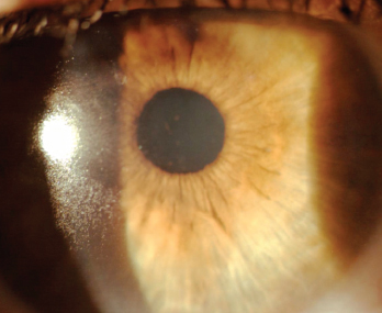 Contact Lens Spectrum | PentaVision