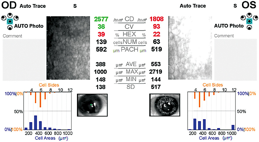 Contact Lens Spectrum | PentaVision