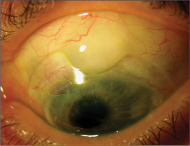 Contact Lens Spectrum | PentaVision