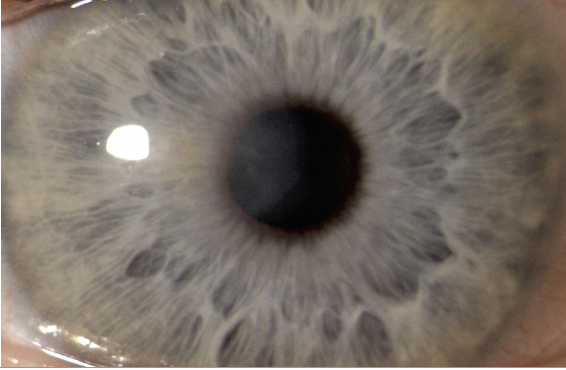 Fitting Multifocal Scleral Lenses For Unilateral Central Corneal Scar ...