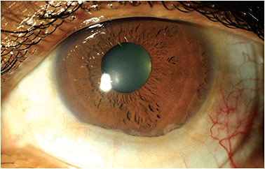 Contact Lens Spectrum | PentaVision