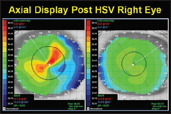 Contact Lens Spectrum | PentaVision