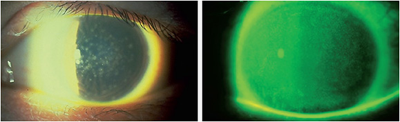 Contact Lens Spectrum | PentaVision