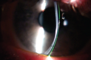 Contact Lens Spectrum | PentaVision