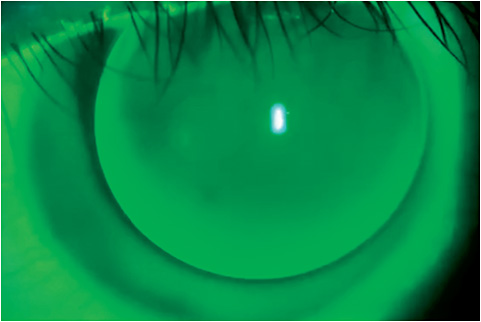 Contact Lens Spectrum | PentaVision