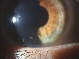 Contact Lens Spectrum | PentaVision