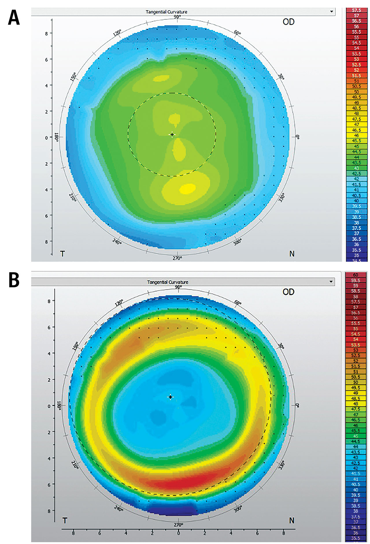 ORTHOKERATOLOGY TODAY | Contact Lens Spectrum