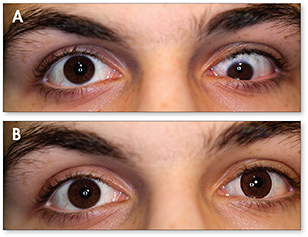 Contact Lens Spectrum | PentaVision