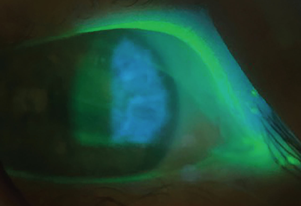 Dry Eye Dx and Tx | Contact Lens Spectrum