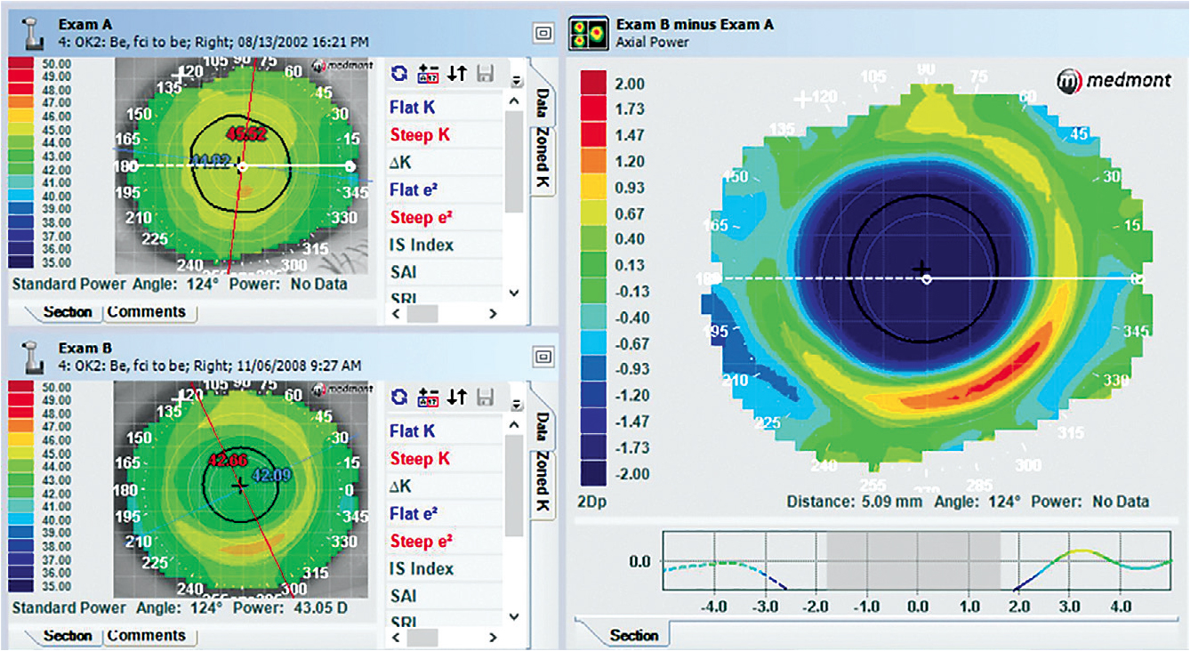 Contact Lens Spectrum | PentaVision