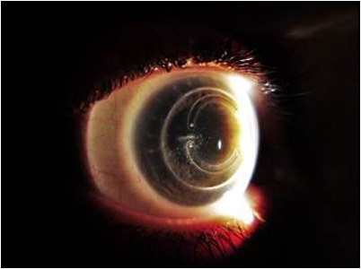 ONLINE PHOTO DIAGNOSIS | Contact Lens Spectrum