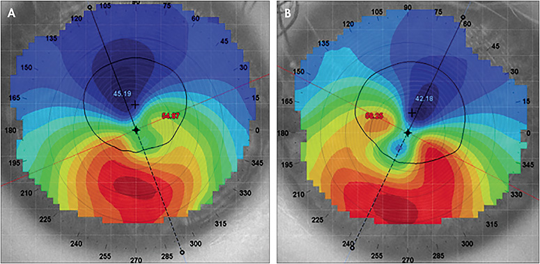 Contact Lens Spectrum | PentaVision