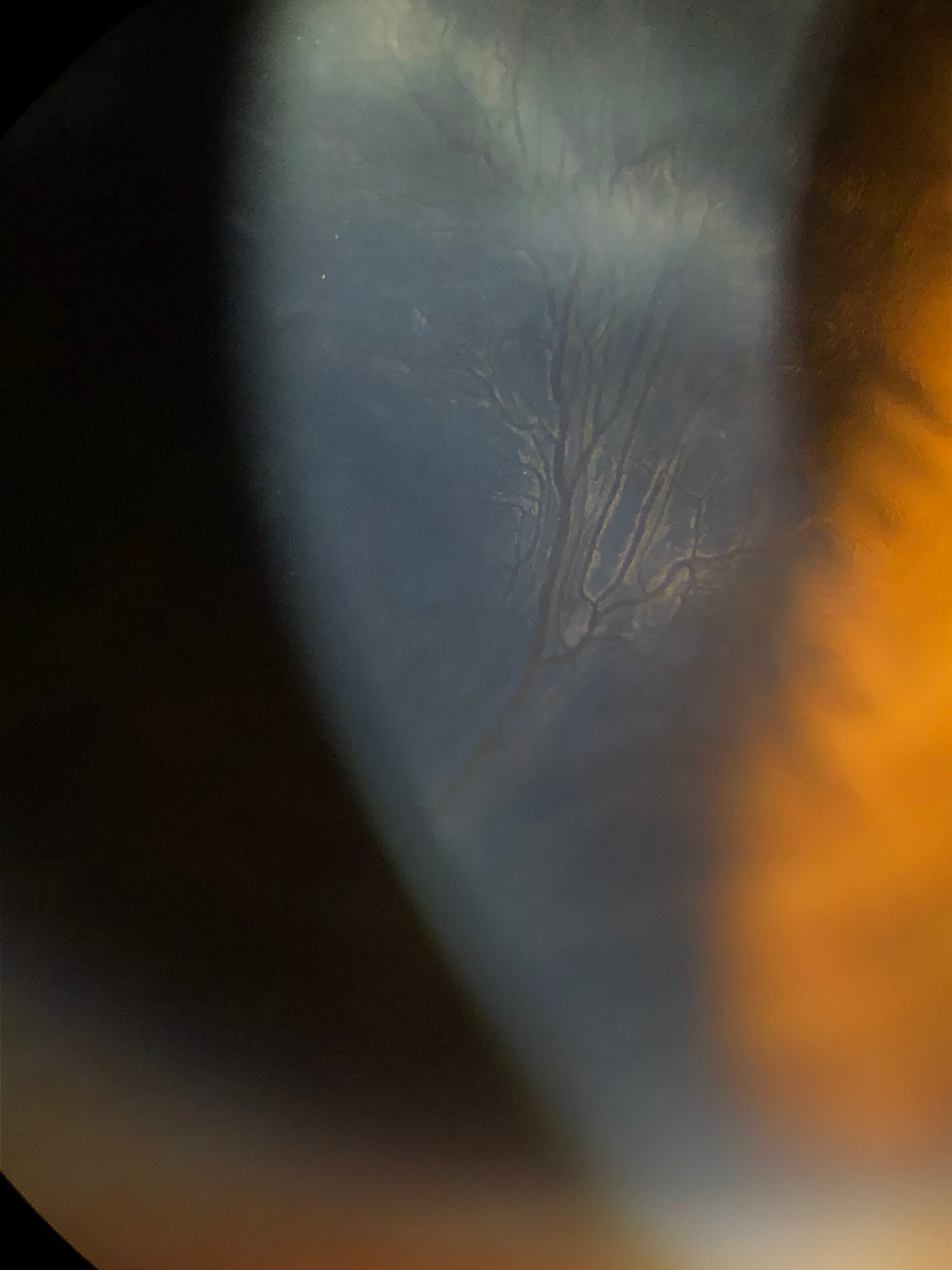 Contact Lens Spectrum | PentaVision