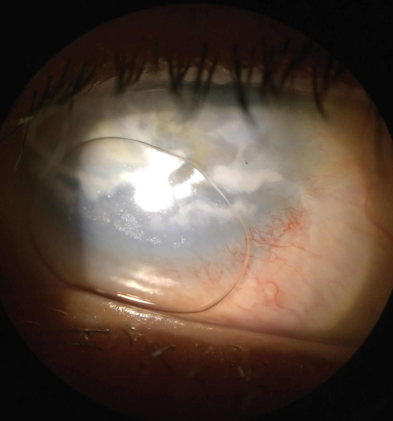 ONLINE PHOTO DIAGNOSIS | Contact Lens Spectrum